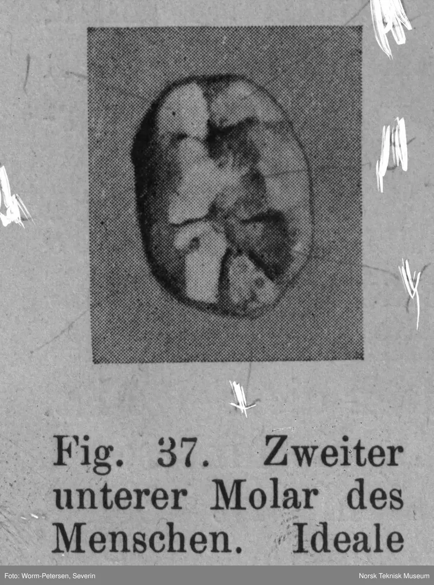 Andre molar i underkjeven hos mennesket. -Norsk Teknisk Museum ...